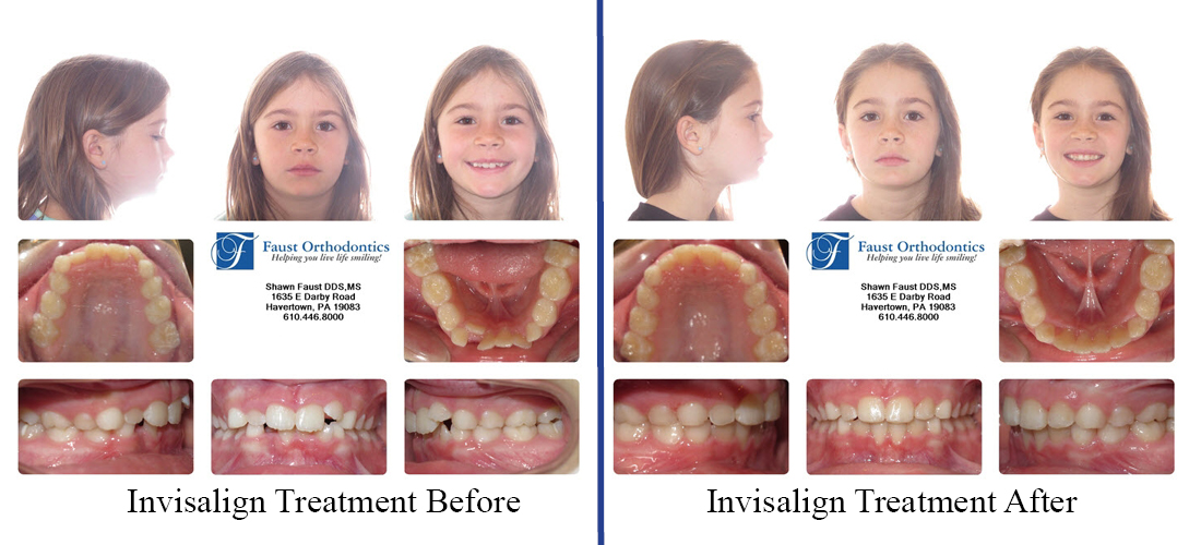 Invisalign First - Early Treatment Haverford | Faust Orthodontics
